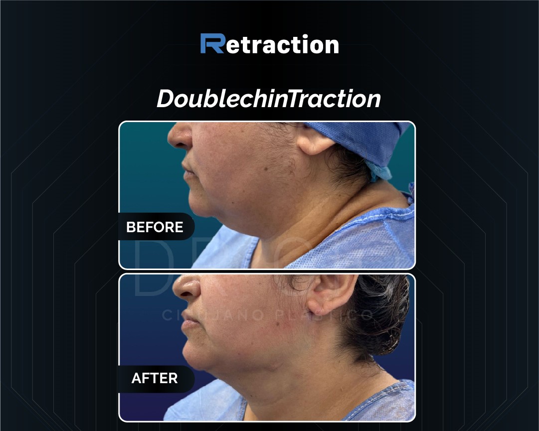 Miami Retraction Lipo Surgery | Radiofrequency Lipo & Fat Removal
